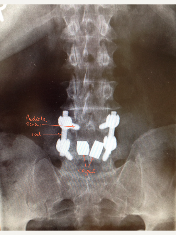 Pars Defect Repair Spines Dorset