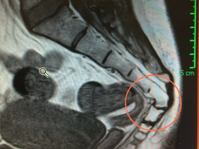 Coccygectomy - Spines Dorset