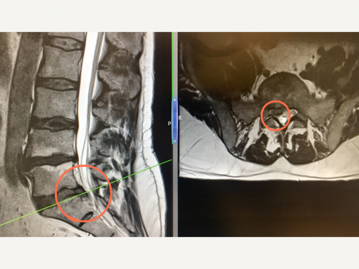 Lumbar Microdiscectomy Spines Dorset